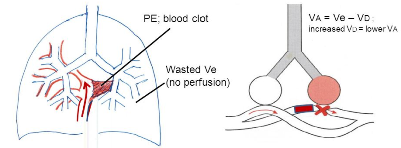 Hypoxia and pulmonary embolism (PE): Mechanism | Medicine Specifics